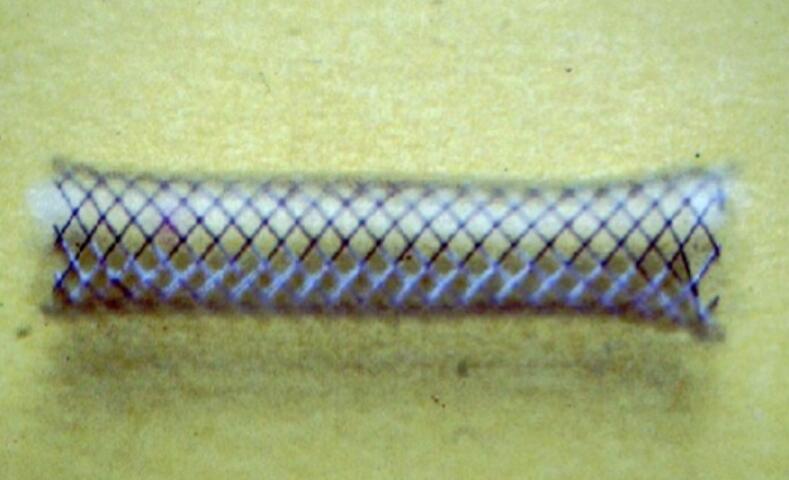 图2 1980年代最早的Wallstent