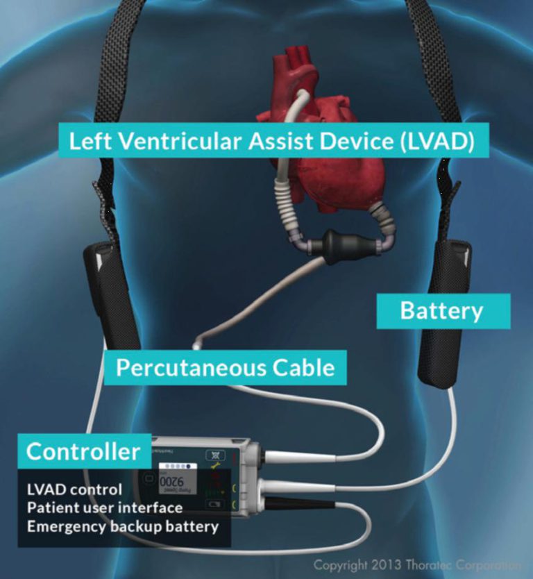 图2 . L V A D 的外部设备。Left Ventricular Assist Device – 左心室辅助装置；