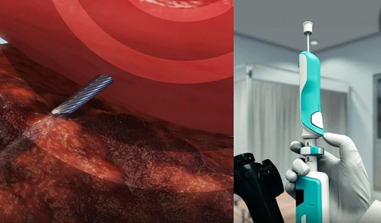 2023上海医疗器械创新展 Medtec创新展速递，Limaca Medical 宣布，其 Precision-GI™ 内窥镜超声活检设备 已 ...