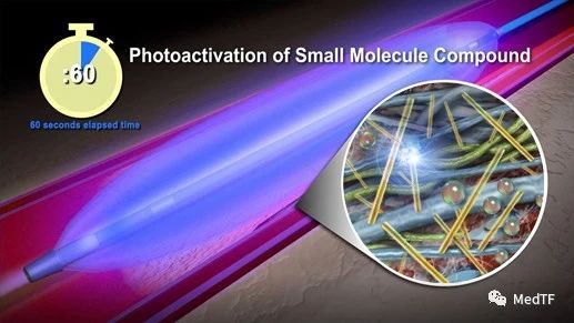 Alucent NVS 光纤开启 。光源会激活渗透到动脉组织中的小分子化合物，从而在血管壁固化。