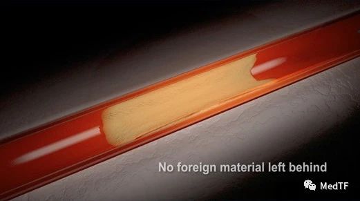 血管壁形成一层类似于支架支撑物的天然固化层，可以 有效避免再狭窄。