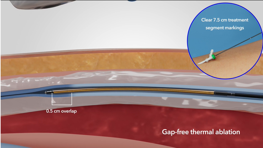 ClosureFast由三部分组成：消融导管、消融管心针和主机。