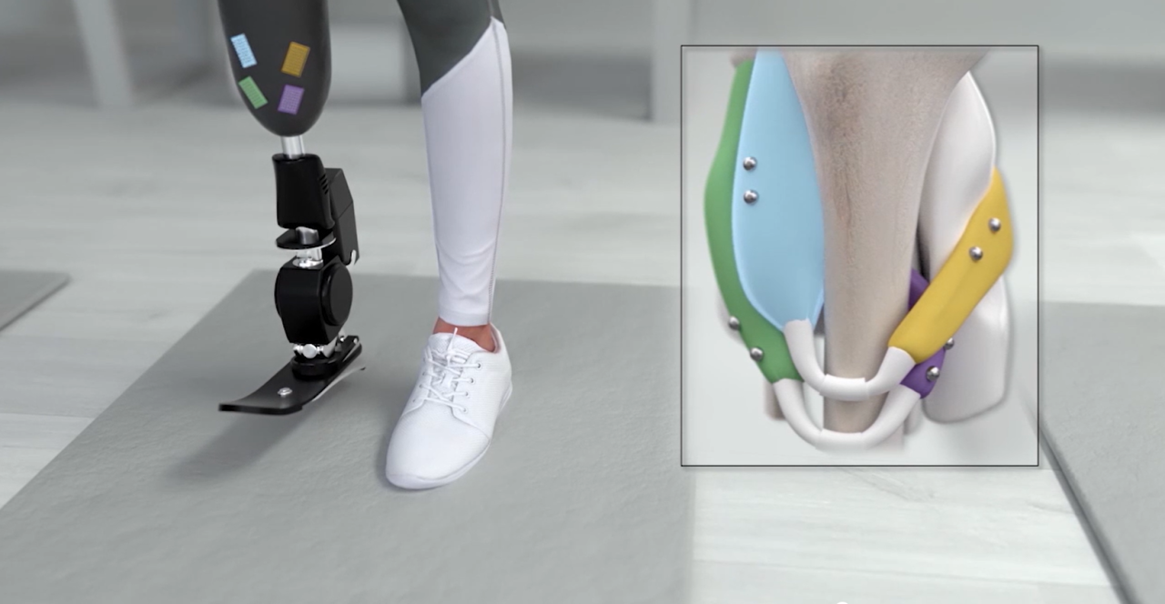 Magnetic Implants for Muscle Tracking — MIT Media Lab